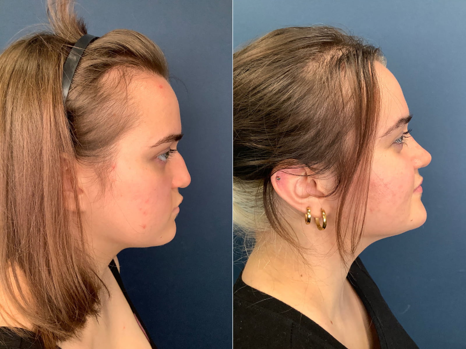 Why Rhinoplasty Results Look Better Over Time Claytor Noone Plastic Surgery