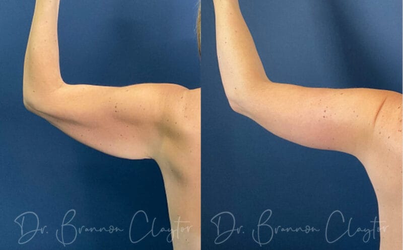 Are Arm Lifts Permanent? How to Make Your Brachioplasty Results Last ...